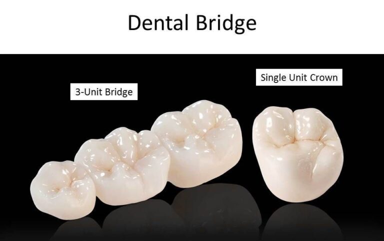 Porcelain Bridge | Westwood Family Dental
